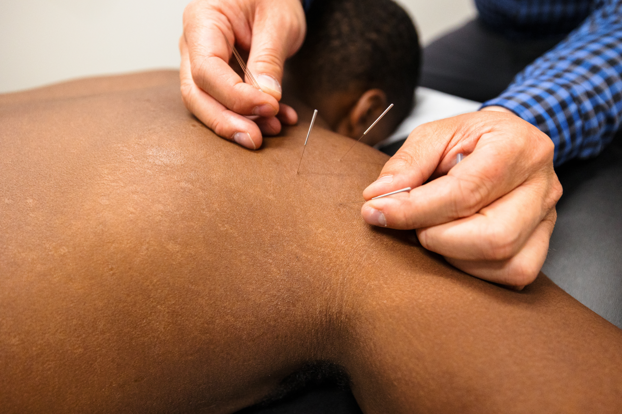 Dry Needling For Shoulder Knots And Tight Traps A Solution For Chronic